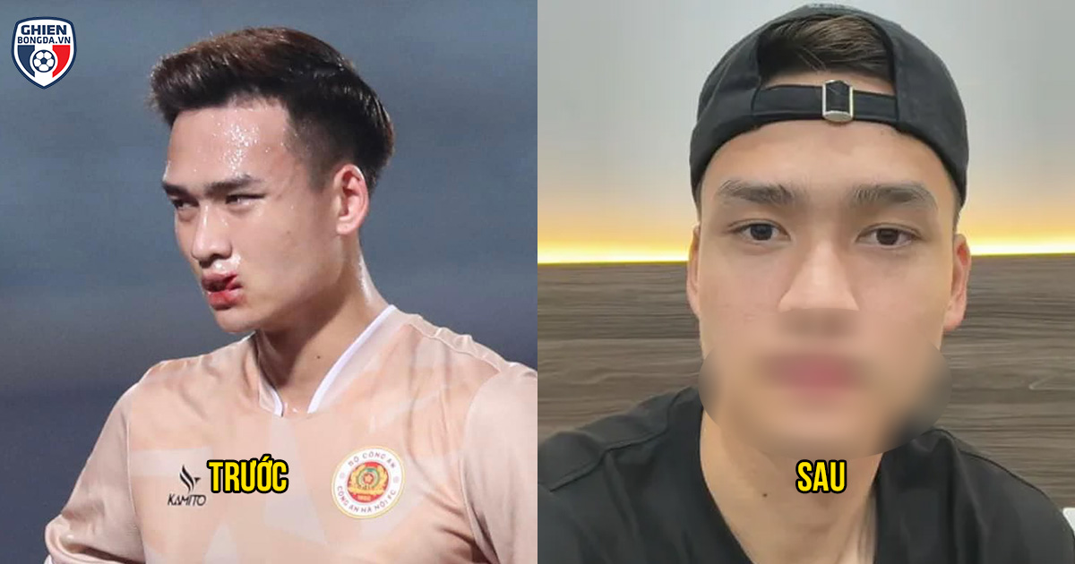 Diện mạo hiện tại của Bùi Hoàng Việt Anh sau 24 mũi khâu vết rách môi ...